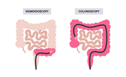 Sigmoidoscopy Vector Images (27)