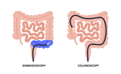 Sigmoidoscopy Vector Images (27)