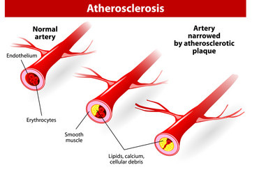 Atherosclerosis Royalty Free Vector Image Vectorstock