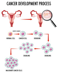 Ovarian cancer diagram in woman Royalty Free Vector Image
