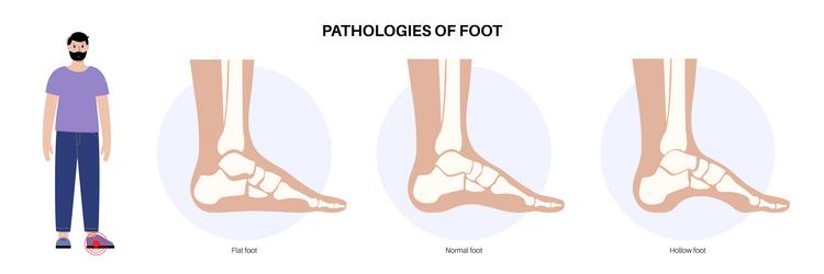 Foot pathologies poster Royalty Free Vector Image