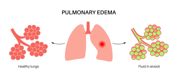 Pulmonary edema disease Royalty Free Vector Image