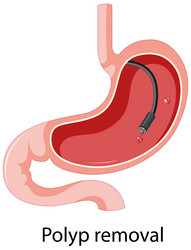 Stomach polyp disease Royalty Free Vector Image