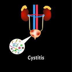 Cystitis Vector Images (over 870)