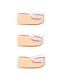 Concave nail plate type growth direction Vector Image
