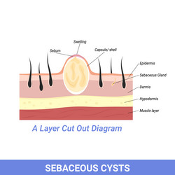 Cyst Diagram