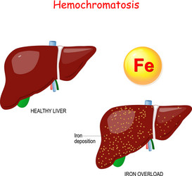 Hemochromatosis Vector Images (30)