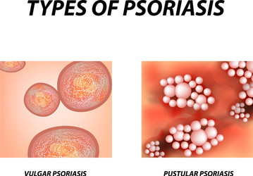 Pustular type psoriasis texture eczema skin Vector Image