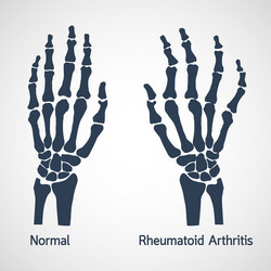 Rheumatoid arthritis icon Royalty Free Vector Image