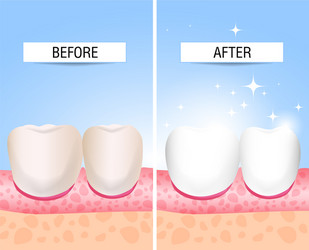Dentistry teeth treatment whitening Royalty Free Vector