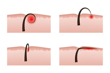 Subcutaneous Acne Vector Images (37)