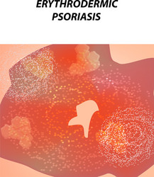 Types of psoriasis pustular Royalty Free Vector Image