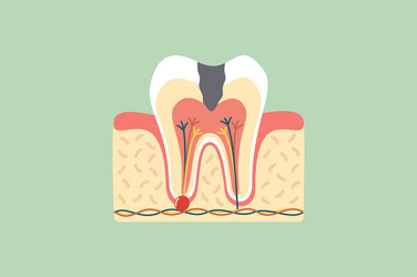 Tooth Decay Vector Images (over 3,600)