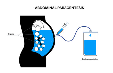 Paracentesis Vector Images (33)