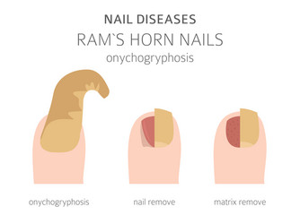 Diseases of Toenails Vector Images (over 140)