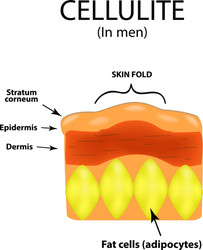 Cellulitis and skin aging in men and women Vector Image