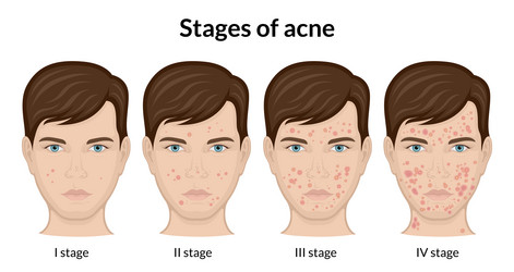 Types of acne Royalty Free Vector Image - VectorStock