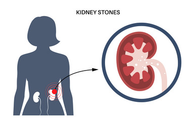 Kidney stones treatment Royalty Free Vector Image