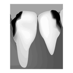 Dental caries x-ray tooth decay Royalty Free Vector Image