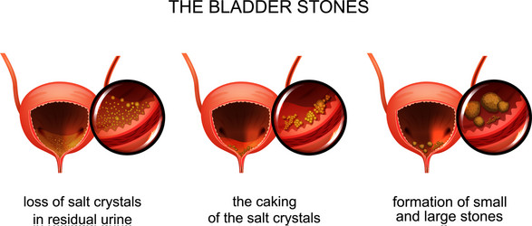 Abdominal Swelling Vector Images (over 230)