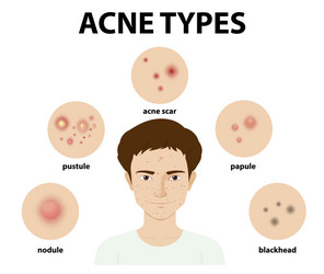 Pimple Clipart