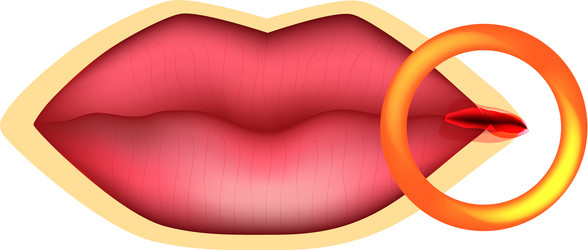 Causes of lip cracks in the corners Royalty Free Vector