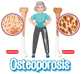 Comparison of normal bone and bone Royalty Free Vector Image