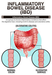 Inflammatory bowel disease ibd infographic Vector Image