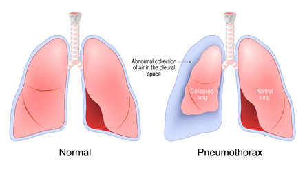 Pneumothorax anatomical poster Royalty Free Vector Image
