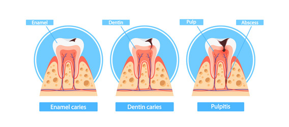 Caries stages infographics healthy tooth enamel Vector Image