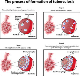 Lung Tubercle Tuberculosis Vector Images (14)