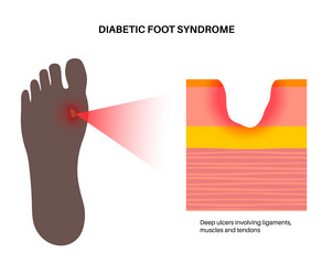 Diabetic foot ulcers Royalty Free Vector Image