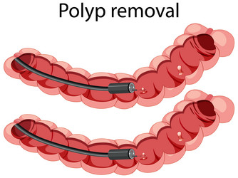 Diagram showing asthma on transparent background Vector Image