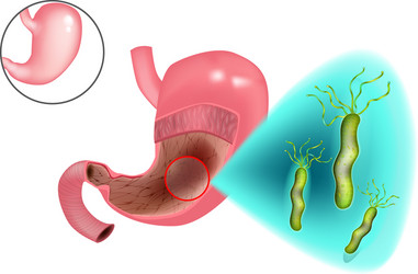 Structure of helicobacter pylori infographics Vector Image