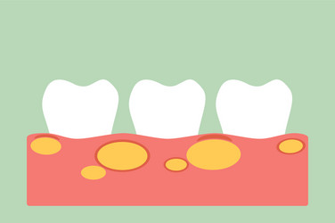 Gingivitis gum disease and sad teeth cartoon Vector Image