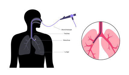 Bronchoscopy procedure concept Royalty Free Vector Image