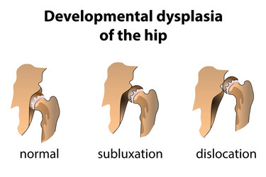 Dysplasia of the hip Royalty Free Vector Image