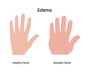 Edema arm swollen hand fingers wrist forearm Vector Image