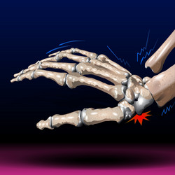 Hand bone fracture - distal radius fracture Vector Image