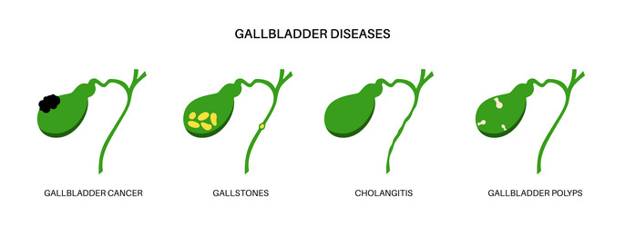 Gallbladder Stone Vector Images (over 120)