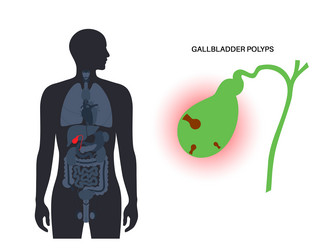 Gallbladder polyp anatomy Royalty Free Vector Image
