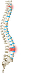 Spine Back Pain Diagram Vector Images (over 160)
