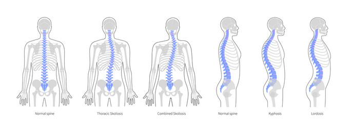 Normal spine and spinal deformity from scoliosis Vector Image