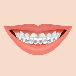 Teeth with braces woman smile isolated on white Vector Image