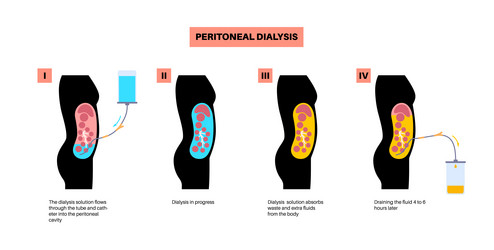 Peritoneal dialysis concept Royalty Free Vector Image