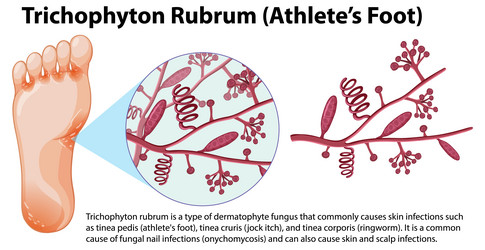 Trichophyton rubrum fungal infection Royalty Free Vector