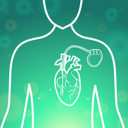 Pacemaker Vector Images (over 870)