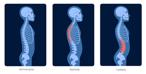 Normal spine and spinal deformity from scoliosis Vector Image
