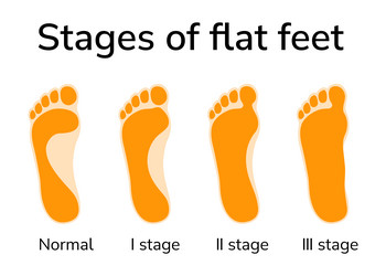Stages of flatfoot progression Royalty Free Vector Image