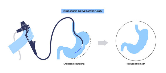 Gastrectomy and gastroplasty Royalty Free Vector Image